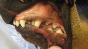 Overbite (Type 2 Malocclusion)